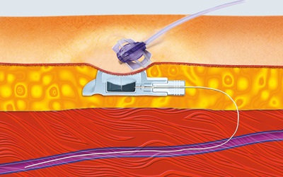 Pflegeratgeber Portsysteme | pfm medical ag