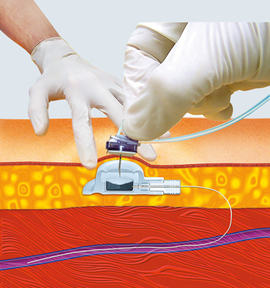 Pflegeratgeber Portsysteme | pfm medical ag